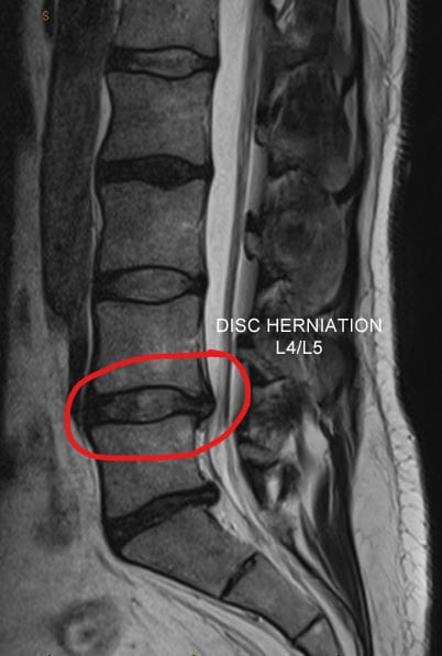 Apa Itu Slip Disc? - Flexphysiotherapy