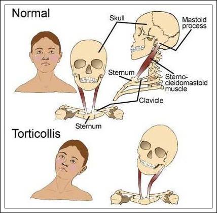 Kenapa Tortikolis Perlu Dipulihkan/Dirawat? - Flexphysiotherapy