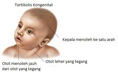 Kenapa Tortikolis Perlu Dipulihkan/Dirawat? - Flexphysiotherapy