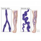 Urat bersimpul, biru, timbul di betis - Flexphysiotherapy