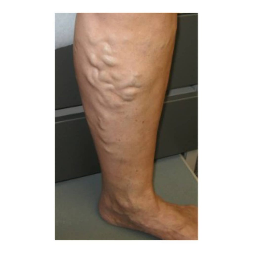 Urat bersimpul, biru, timbul di betis - Flexphysiotherapy