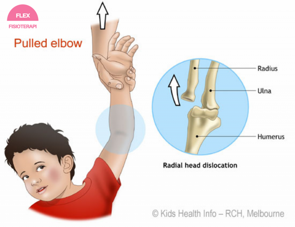 Risiko sendi siku teralih bagi anak kecil - Flexphysiotherapy