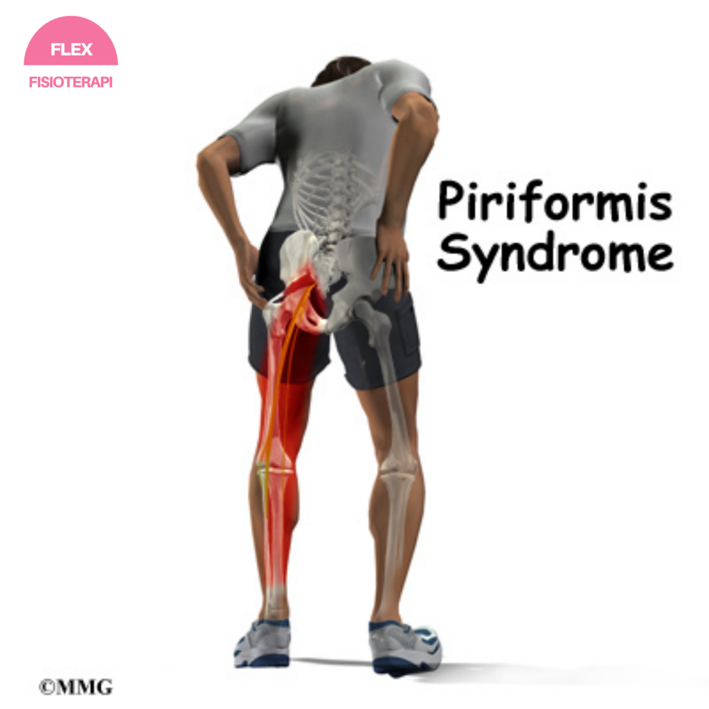 sakit sendi pinggul, sakit kebas hingga kaki - Flexphysiotherapy