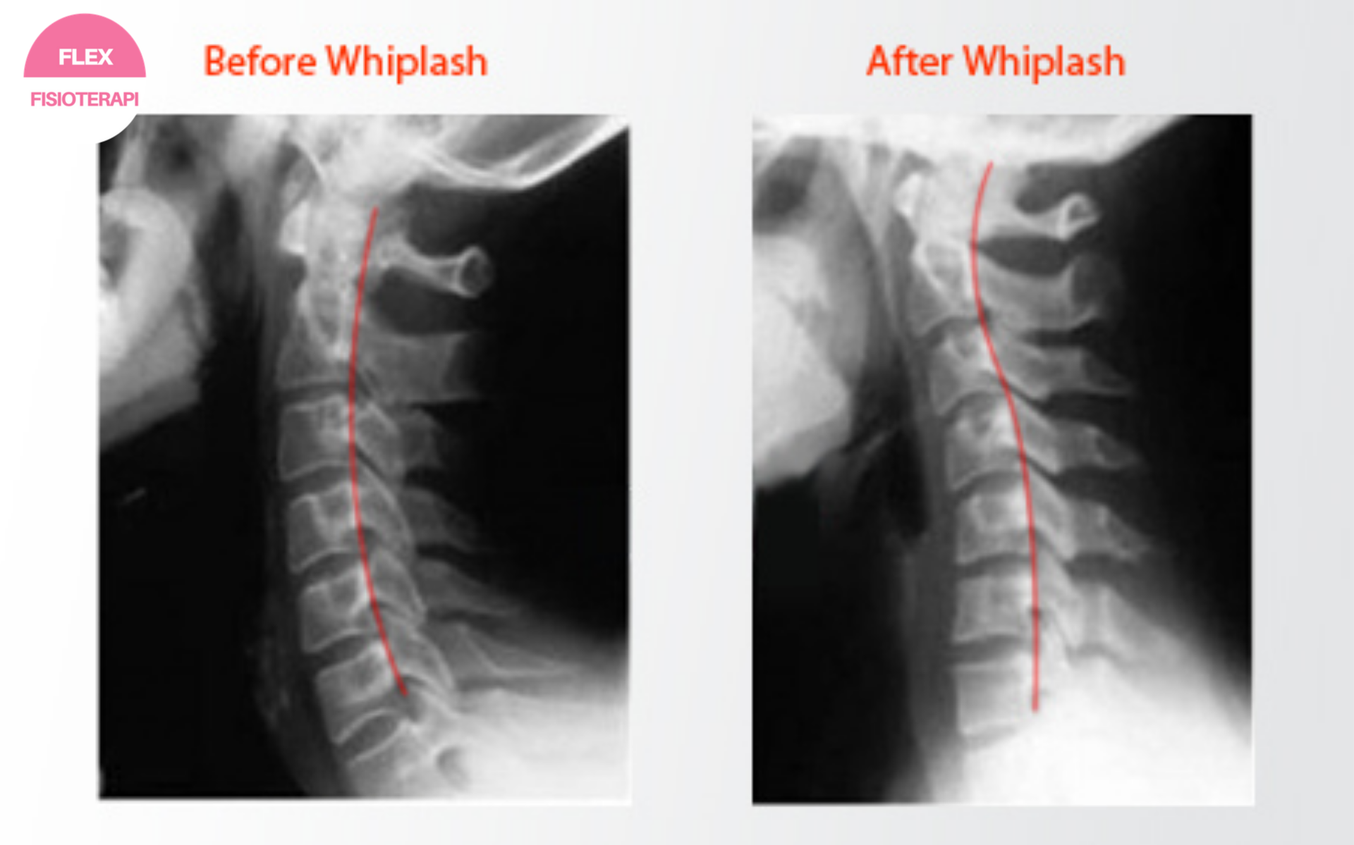Rawat kecederaan leher akibat kemalangan - Flexphysiotherapy