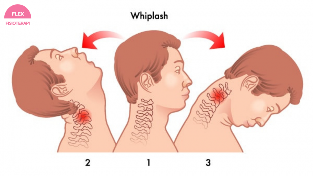 Rawat kecederaan leher akibat kemalangan - Flexphysiotherapy